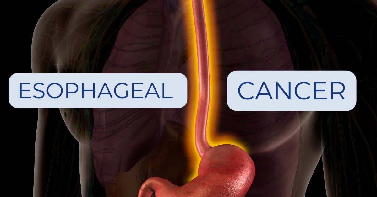 What is Esophageal Cancer? - Pi Health Cancer Hospital